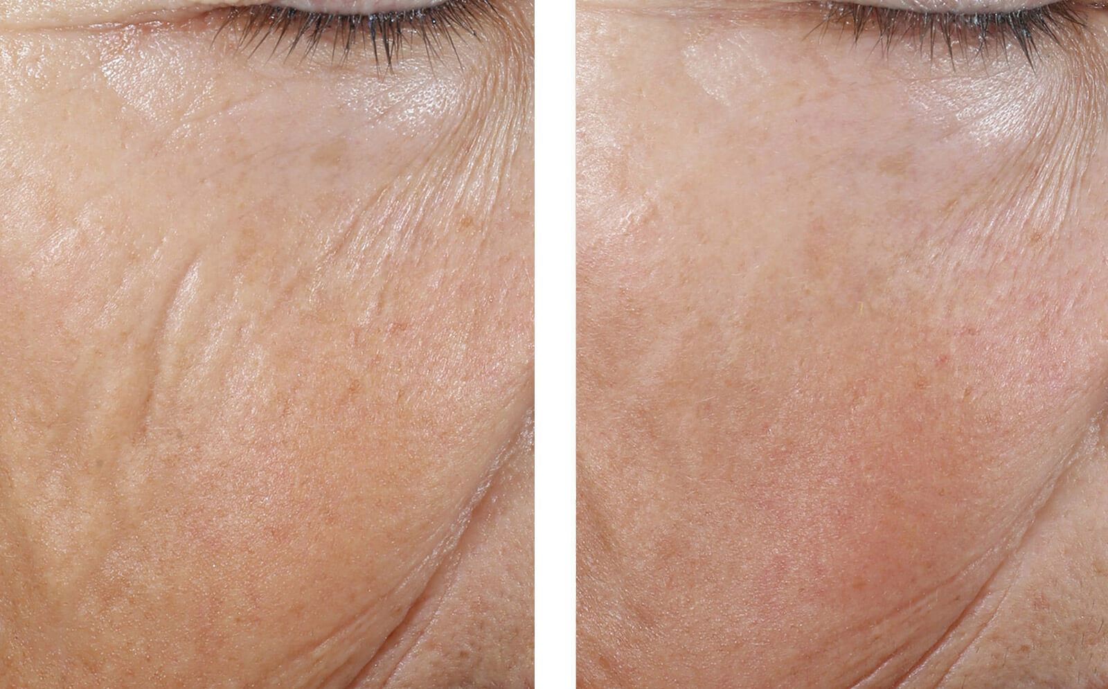 InterFuse - Intensive Treatment LINES - SkinBetter Science