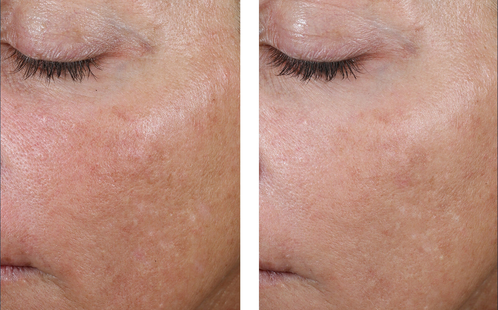 AlphaRet Overnight Cream - Retinoid Cream - SkinBetter Science