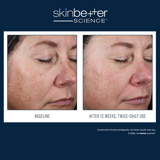 AlphaRet Collection - Retinoid & AHA Skincare - SkinBetter Science